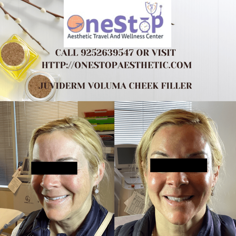 Best Cheek filler in Dublin | Juvederm | Restylane