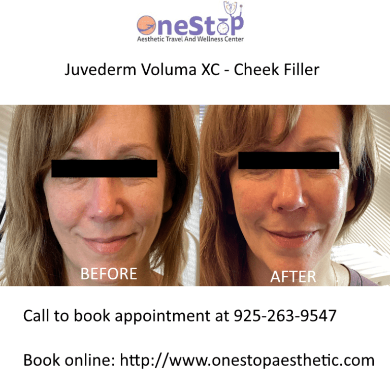 Best Cheek filler in Dublin | Juvederm | Restylane