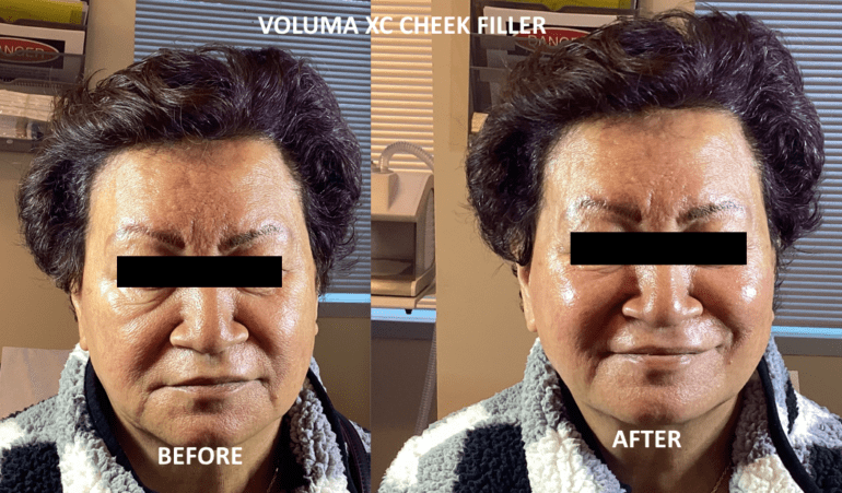 Best Cheek filler in Dublin | Juvederm | Restylane