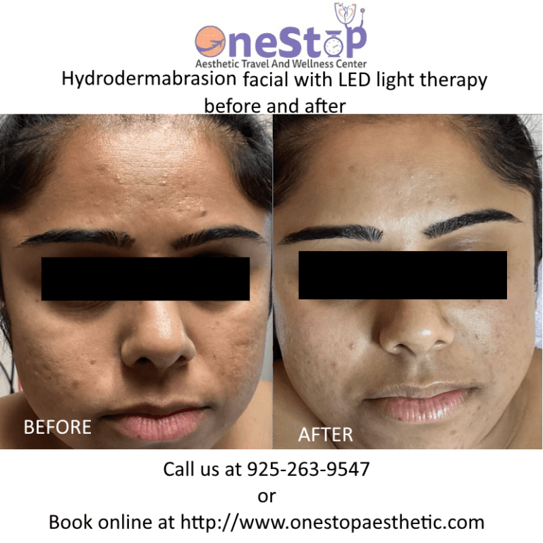 Best Hydrodermabrasion facial near you in San Ramon
